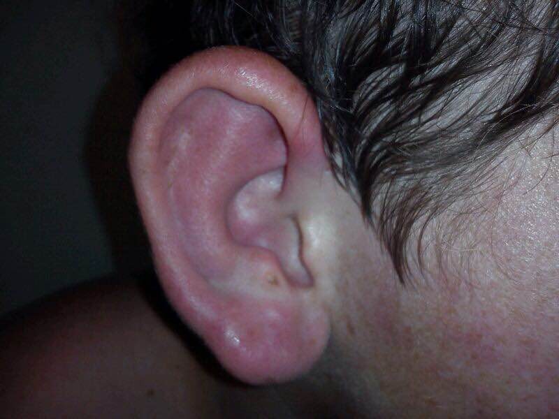 Central Florida New Epicenter of Leprosy in U.S. - CDC Report | Light Wave